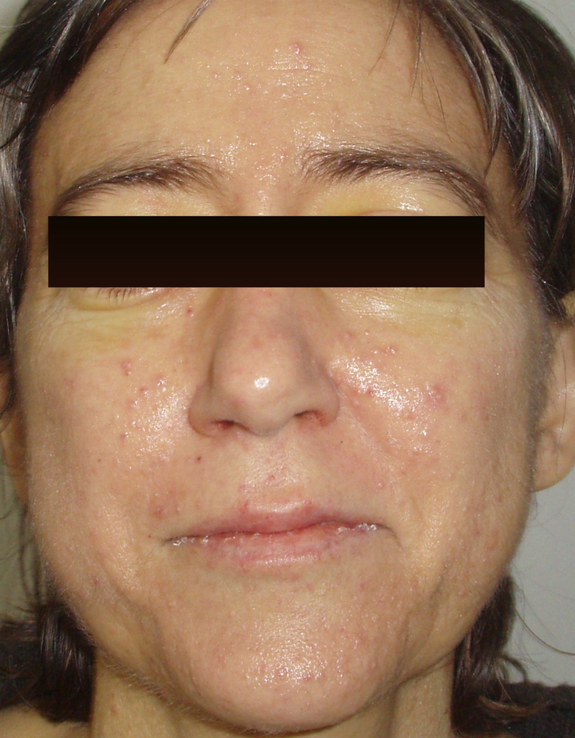 Facial Acneiform Rash Associated With Sorafenib Facial Acneiform Rash Associated With Sorafenib