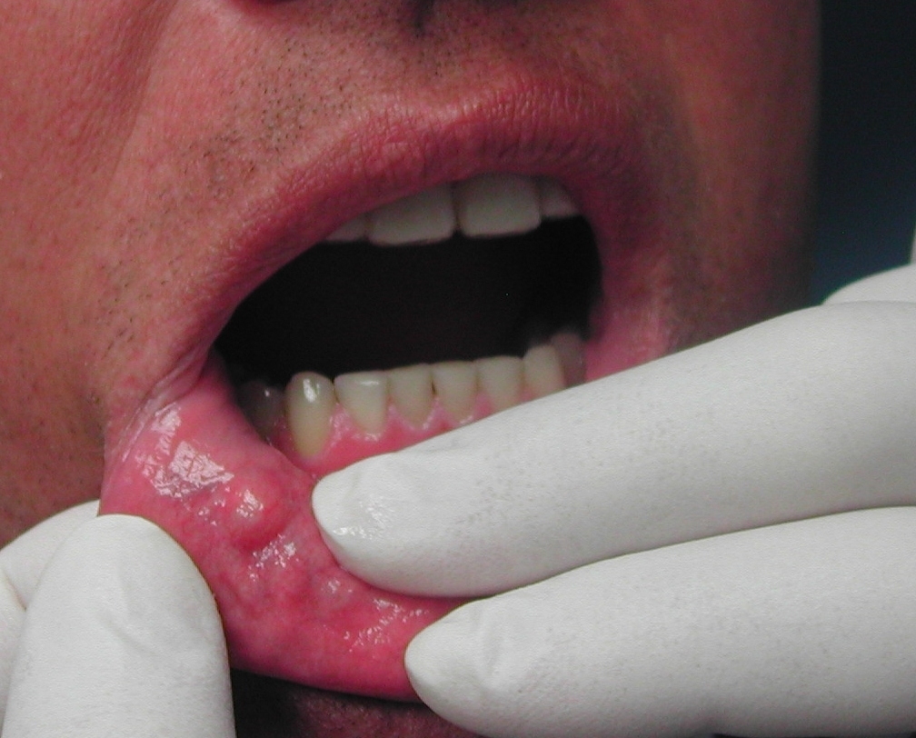 Blocked Salivary Gland Lip