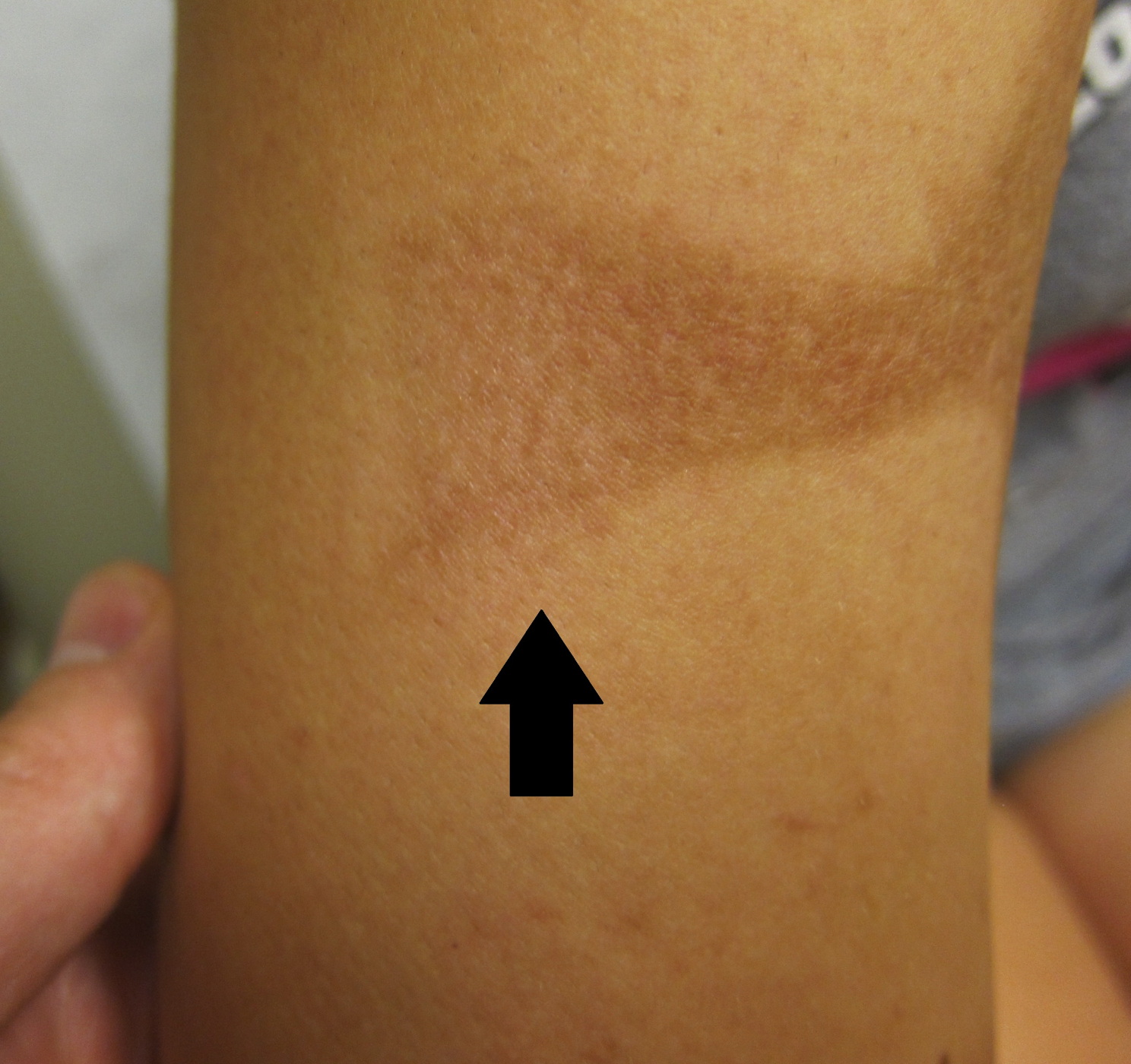 Verr ckt Geworden D nger Geduldig Hyperpigmentation From Laser Burn